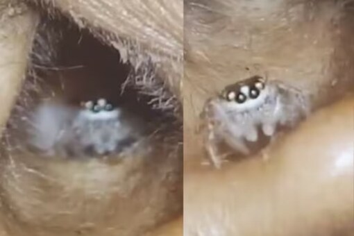 Video Of Spider Crawling Inside Woman's Ear Has Internet Trembling - News18