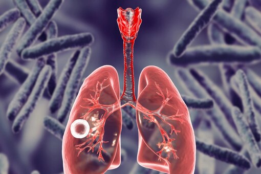 World Tuberculosis Day 2023: Theme, History and Significance - News18