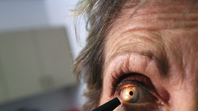 Understanding Cataracts: Causes, Symptoms, and Ayurvedic Perspectives ...