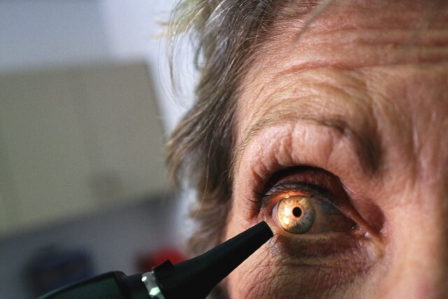 What Are Cataracts? Know Types, Symptoms And Treatment - News18