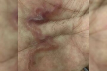 Doctors Find Worms Under Woman's Skin After She Ate... - News18