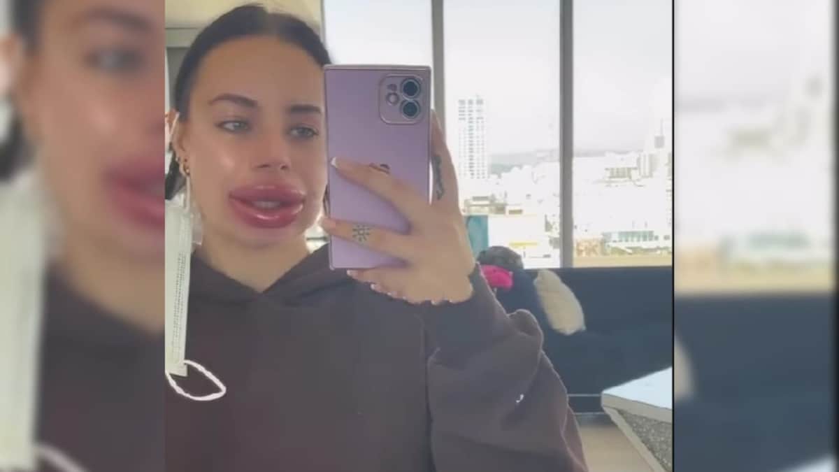 Influencer Ends Up With Massively Swollen Lips After Free Surgery Goes ...