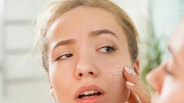 What Is Skin Peeling And Here Is How You Can Avoid It During Summers ...