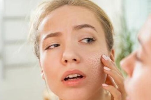 What Is Skin Peeling And Here Is How You Can Avoid It During Summers ...