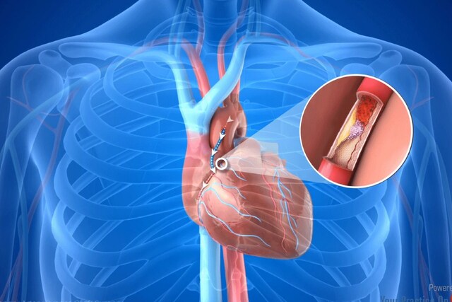 What You Need To Know About Coronary Artery Bypass Grafting - News18
