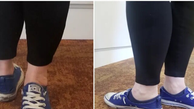 Woman's Back-to-Front Foot Rotation Earns Her A Spot In Guinness World ...