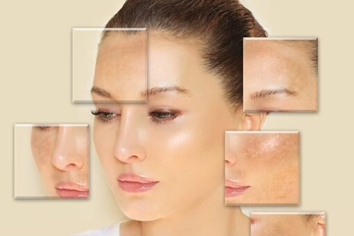 Hyperpigmentation: What To Do To Prevent It? - News18