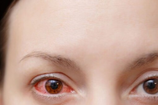 Conjunctivitis Memes Take Over Twitter as Eye Infection Cases Rise in ... Conjunctivitis Memes Take Over Twitter as Eye Infection Cases Rise in ...