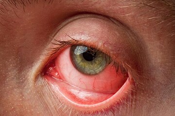 Eye Flu: Know the Causes, Symptoms, Types and Remedies - News18