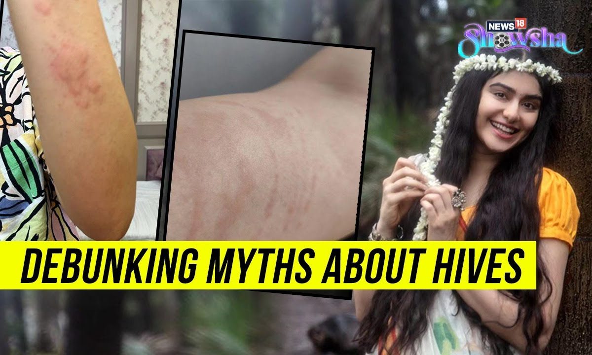 Adah Sharma Shares Health Update After Hives Diagnosis; Know Everything ...