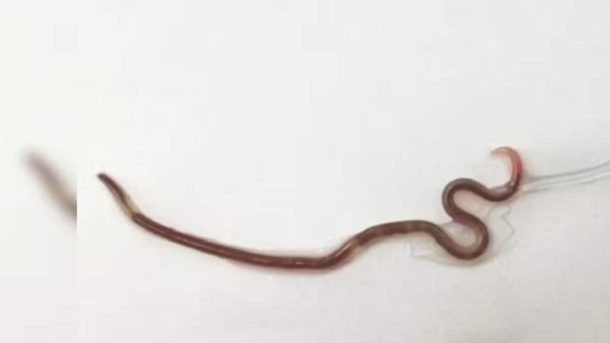 ‘Alive And Wriggling’ Parasitic Roundworm Found Inside Woman’s Brain ...
