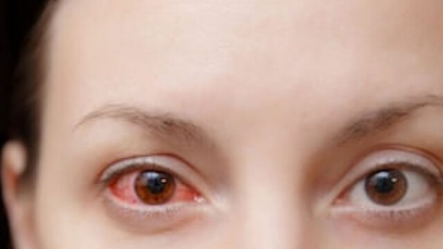 As Conjunctivitis Cases Surge In India, Experts Bust Myths Related To ...