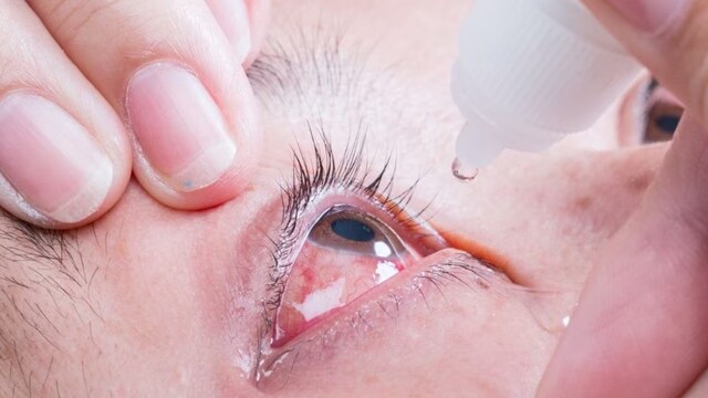 Suffering From Conjunctivitis? Expert Shares Useful Tips | Lifestyle ...