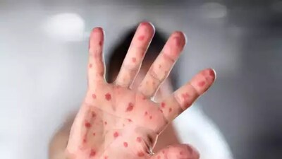 Clade 9 Chickenpox Variant in India: Symptoms, Prevention, and Details ...