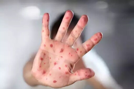 Clade 9 Chickenpox Variant in India: Symptoms, Prevention, and Details ...