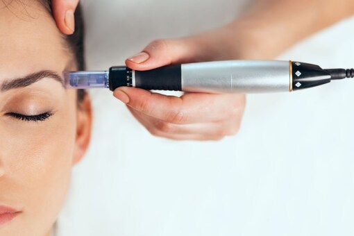 Mesotherapy for The Skin: All You Need To Know - News18