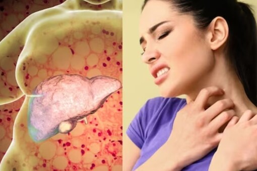 Red Palms To Clubbed Fingers 3 Symptoms Of Cirrhosis News18