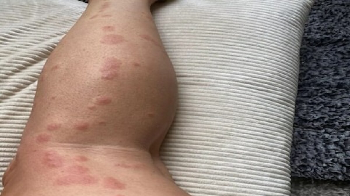 65-year-old UK Woman Finds Herself Covered In 200 Bug Bites At A Hotel ...