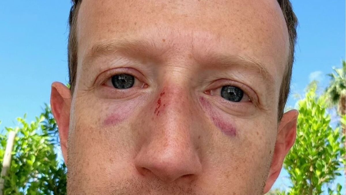 Mark Zuckerberg Shares Selfie With Bruises And Injuries on Face, Here ...