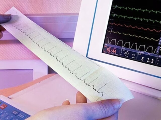 Cardiologist Explains Reasons Behind Normal ECG During Heart Attacks ...