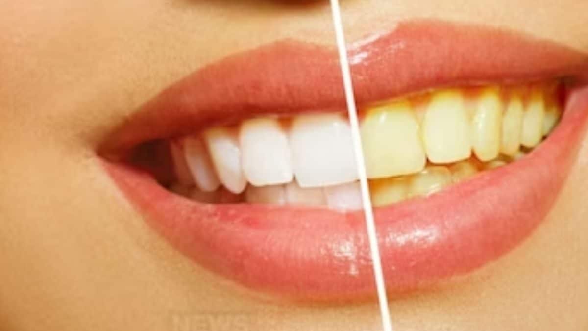 Unlocking Your Smile's Potential: Banish Teeth Stains with These ...