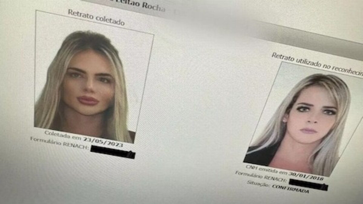 Woman Who Underwent Rs 2.5 Crore Plastic Surgery Now Faces Difficulty ...