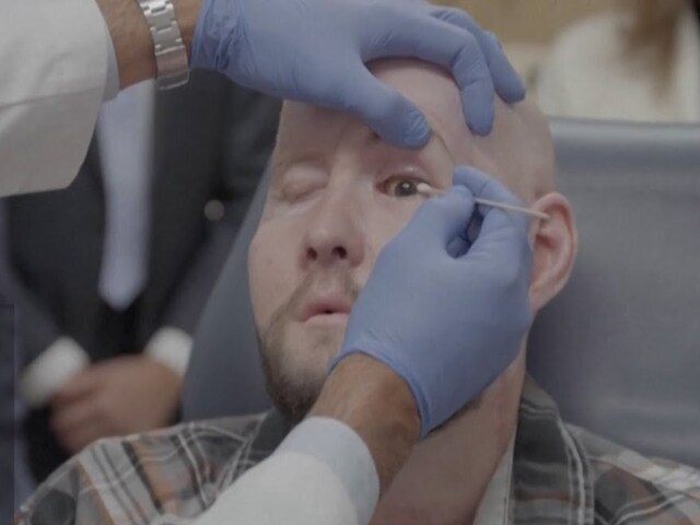New York Surgeons Perform World's First Whole Eye Transplant - News18
