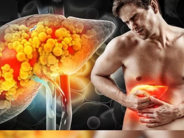 Is Nonalcoholic Fatty Liver Disease A Precursor To Cancer? What We Know ...