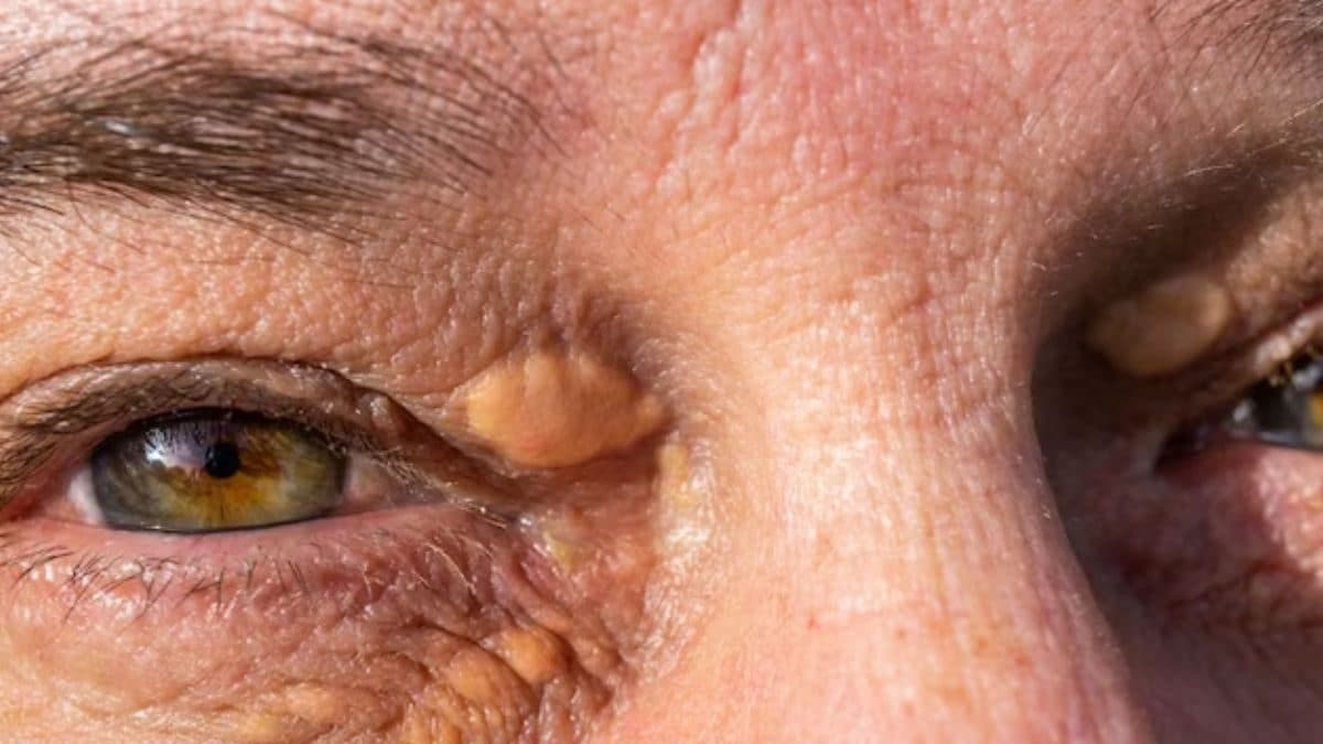 Dry Retina To Blurred Vision, 5 Eye Condition That Can Indicate ...