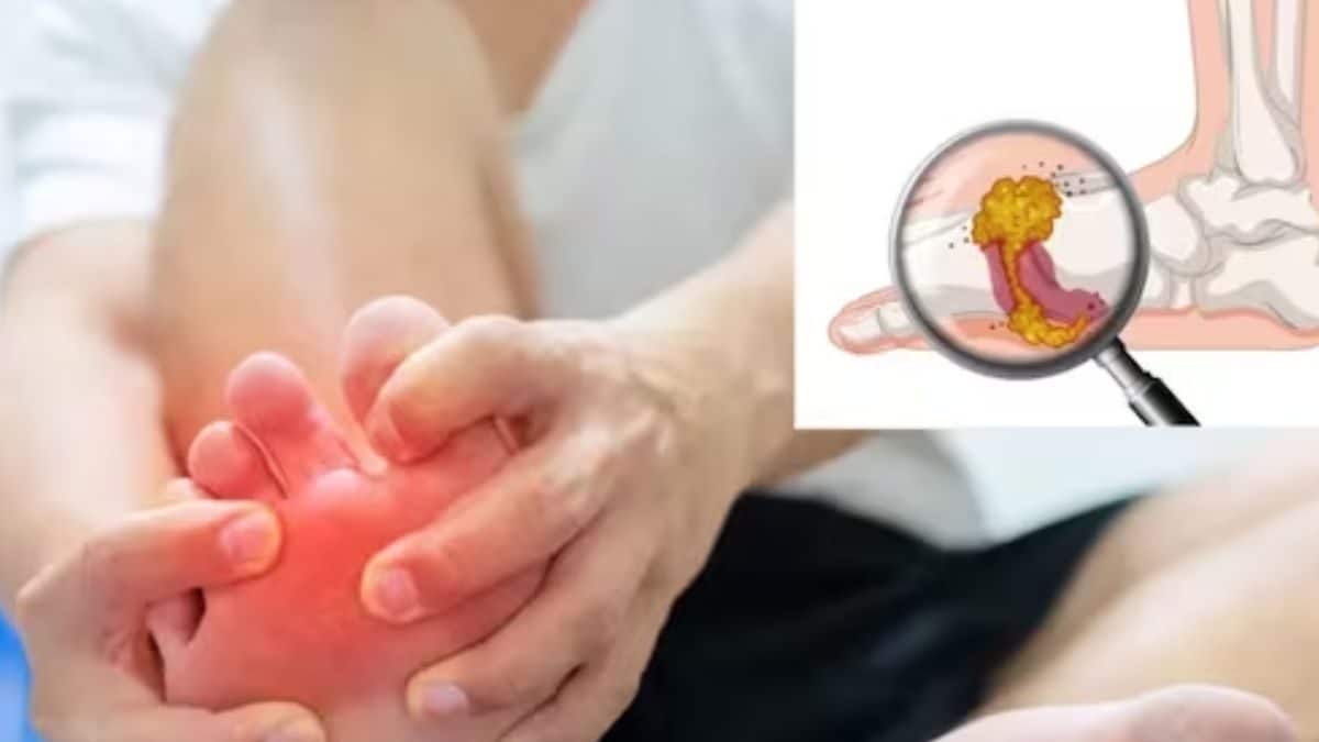 High Uric Acid: Symptoms, Causes, And Lifestyle Changes To Prevent It ...