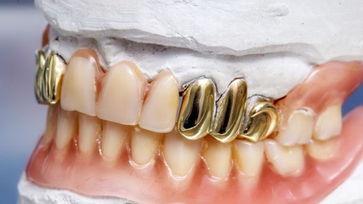 Why Pure Gold Isn't Ideal For Dental Crowns; Dentists Respond - News18