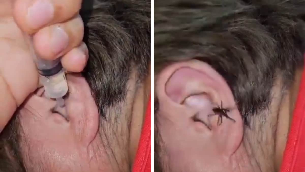 Is It Real? This Video Of Spider Crawling Out Of Man's Ear Is Super ...