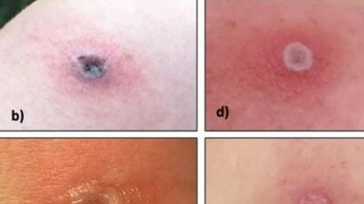 What Is Alaskapox? Explaining Mystery Behind Unusual Virus Spreading In ...