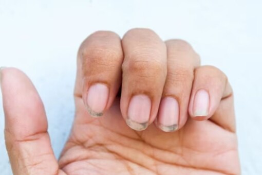 Fingernails May Contain 32 Types Of Bacteria: Here’s How To Keep Them ...