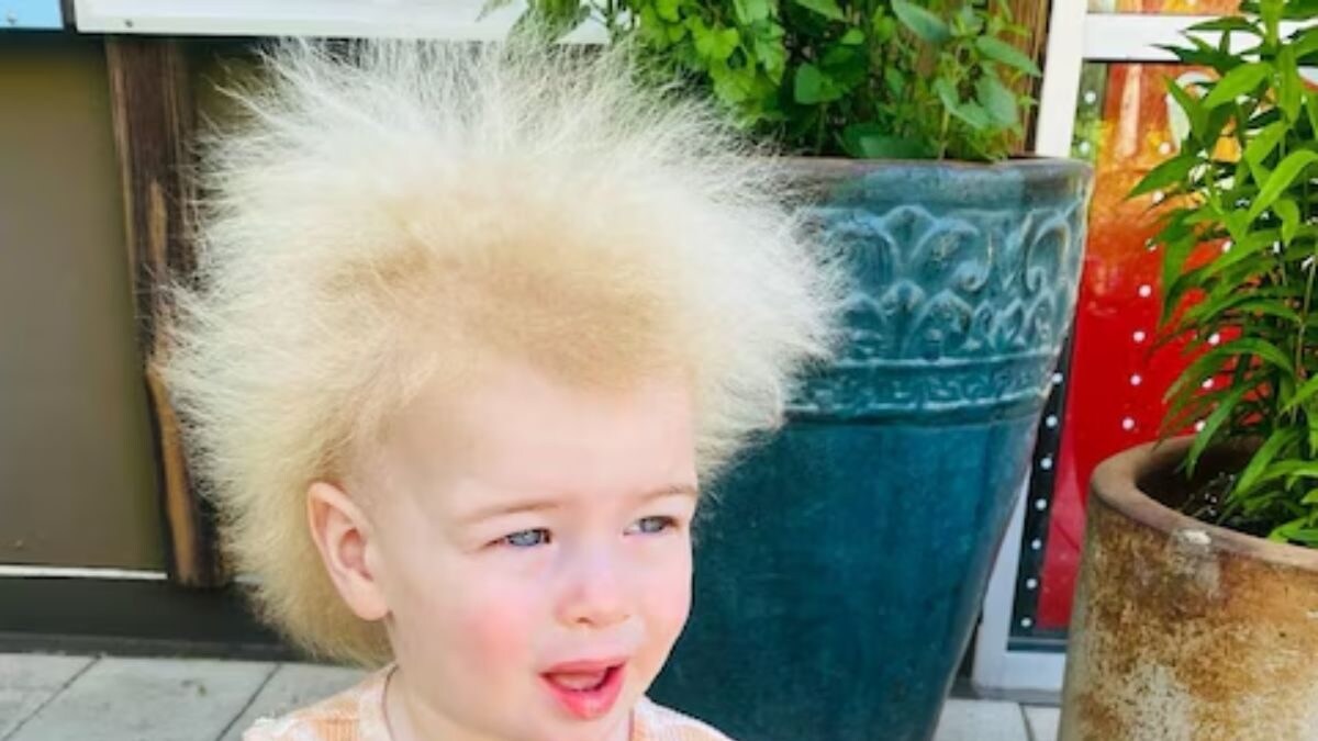 UK Girl Suffers From Rare Condition That Makes Her Hair Uncombable - News18