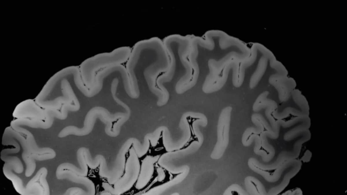 World's Most Powerful MRI Scans First Images Of Human Brain | World ...