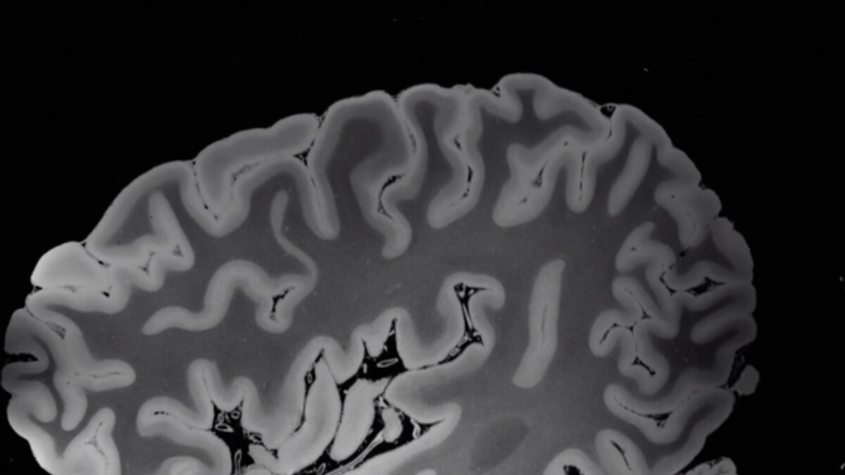 World's Most Powerful MRI Scans First Images Of Human Brain - News18