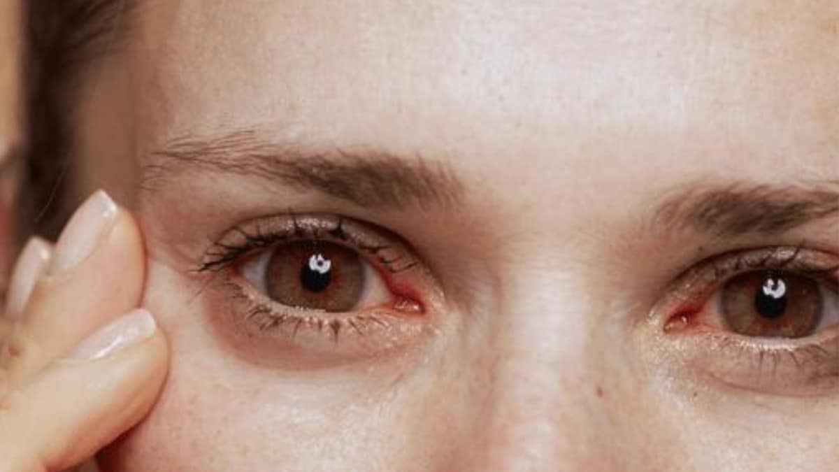 Simple Tips To Prevent Dry Eye Discomfort | Lifestyle News - News18