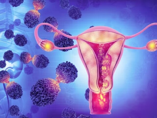 Gynaecological Cancers: Know Types, Symptoms And Preventive Measures ... Gynaecological Cancers: Know Types, Symptoms And Preventive Measures ...