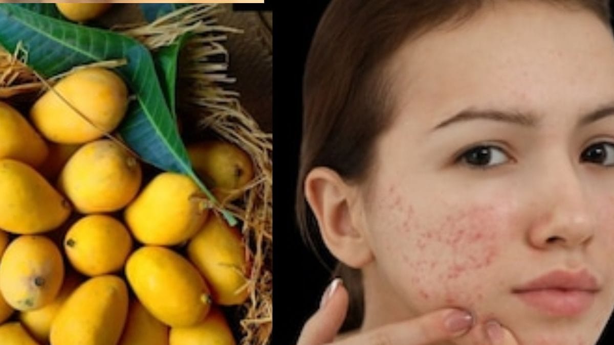 Expert Shares If Eating Mangoes Causes Pimples On Face | Lifestyle News ...