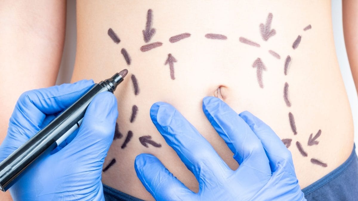 Exploring Non-Surgical Alternatives to Tummy Tucks | Lifestyle News ...