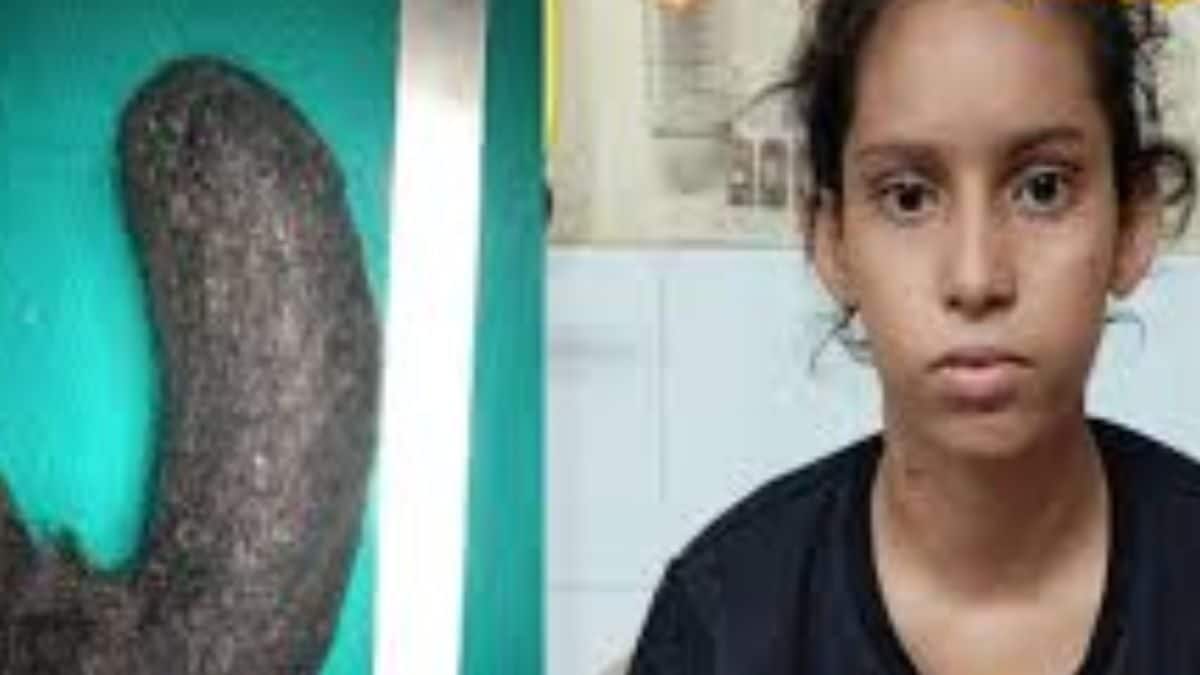 After 5-hour Surgery, 16cm Hairball Removed From 17-year-old Girl's ...