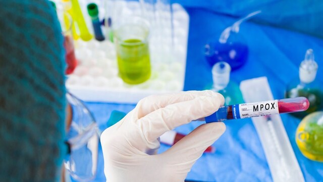Mpox: Symptoms, Treatment And How It Is Different From Chickenpox ...