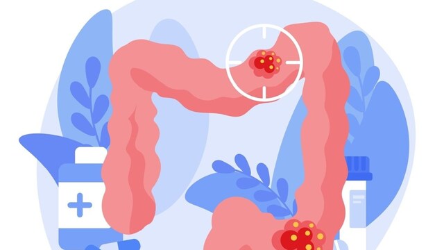 Appendix Cancer in Different Demographics: Are Certain Groups More At ...