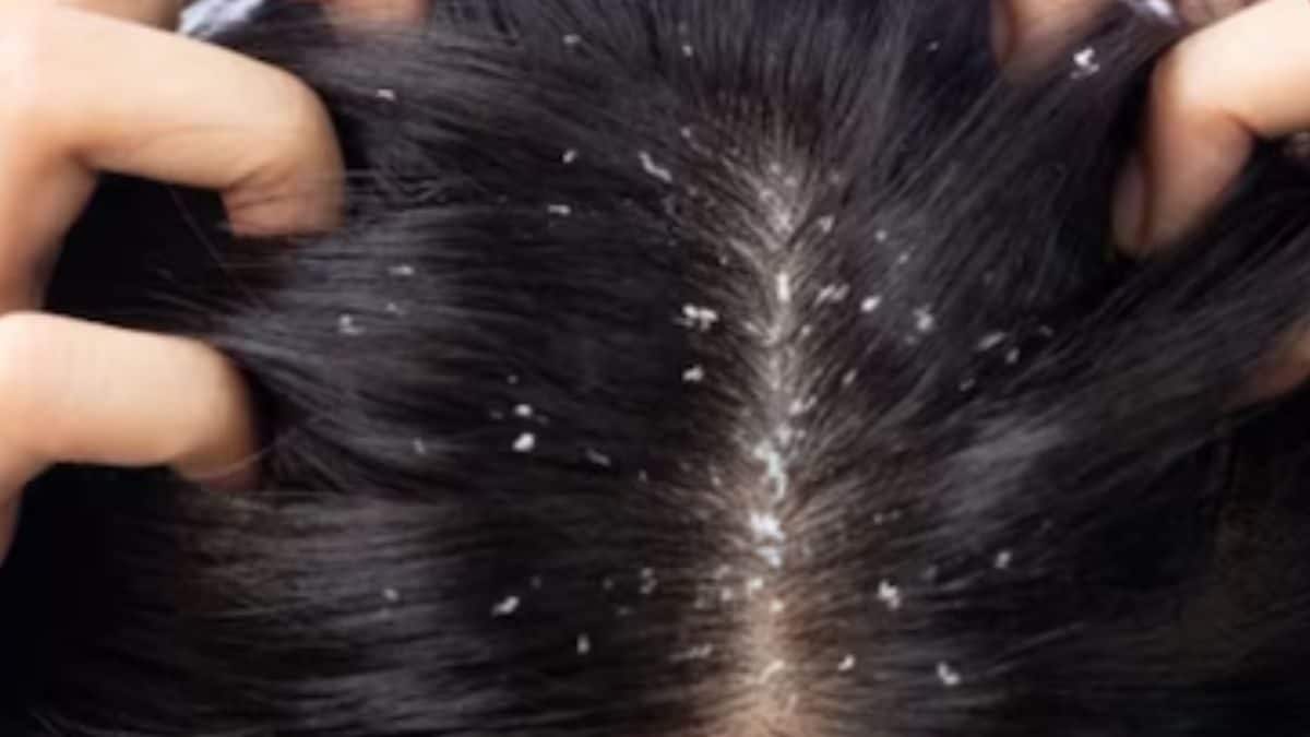 Avarampoo: The Ayurvedic Wonder Flower With Multiple Health Benefits ...