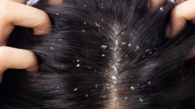 Avarampoo: The Ayurvedic Wonder Flower With Multiple Health Benefits ...