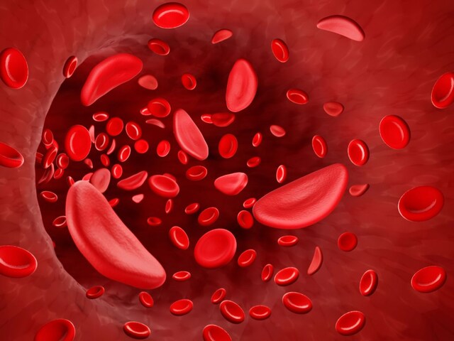 Chhattisgarh, MP & Maharashtra Lead Sickle Cell Anaemia Screening ...