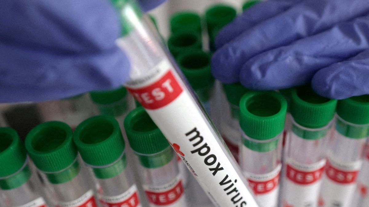 Kerala Confirms Second Mpox Case, UAE Returnee Admitted To Kochi Hospital | India News - News18