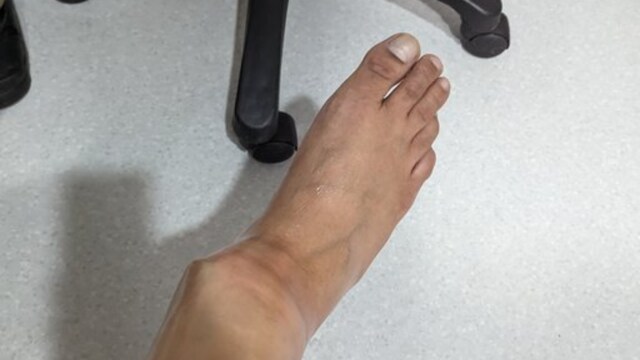 IndiGo Passenger Who Fell On Plane Ramp 3 Months Back At Delhi Airport ...