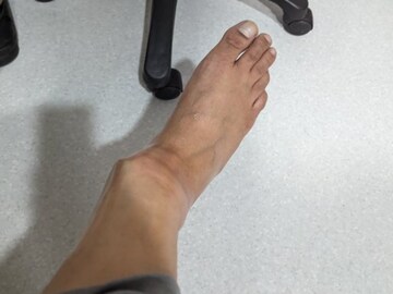 IndiGo Passenger Who Fell On Plane Ramp 3 Months Back At Delhi Airport ...